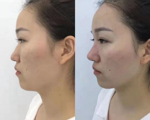 Premium PDO threads | Nonsurgical Facelift Products