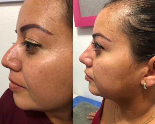 Premium PDO threads | Nonsurgical Facelift Products