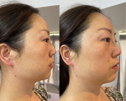 Premium PDO threads | Nonsurgical Facelift Products