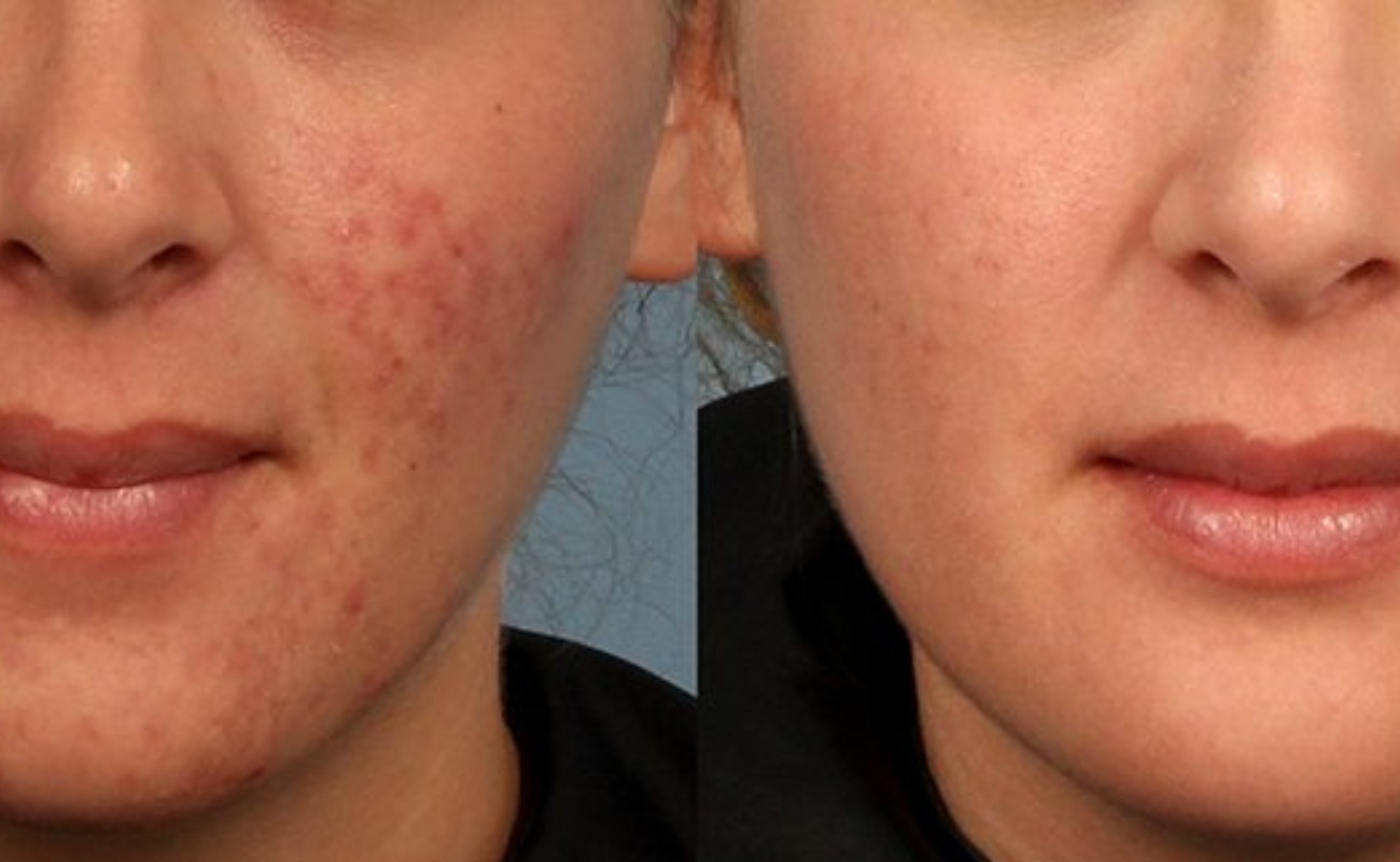 Derma Roller - Mesotherapy Stool with Multiple Functions