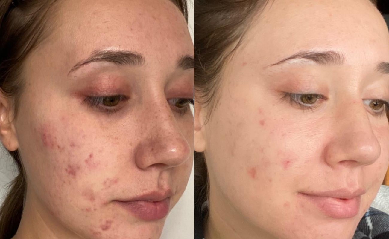 Derma Roller - Mesotherapy Stool with Multiple Functions