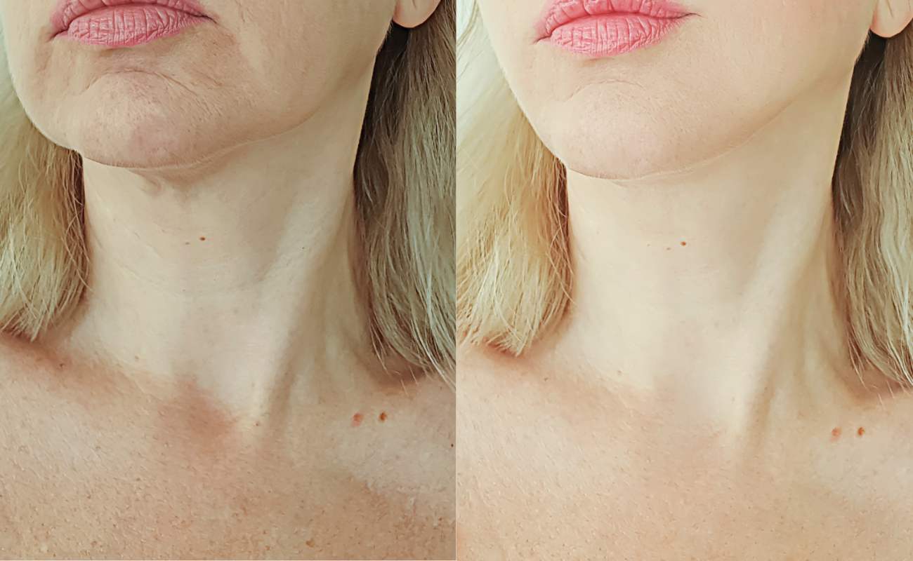 Diaminy PLLA threads for lifting and tightening the face & body